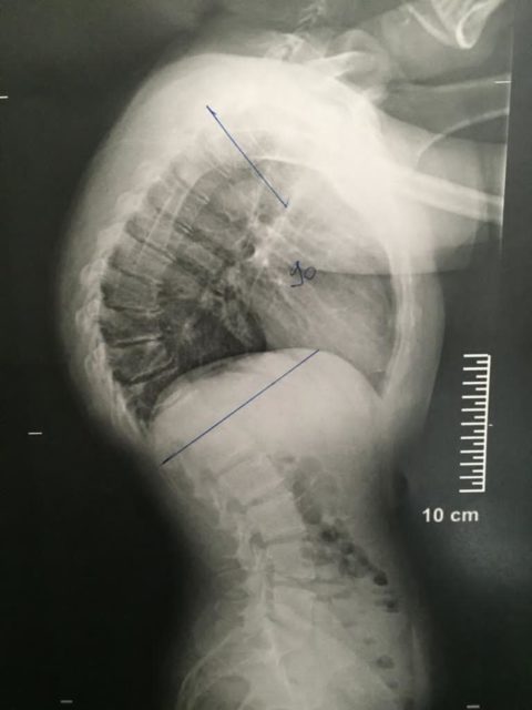 La Cyphose | Docteur Pierre Moreno - Chirurgien du rachis