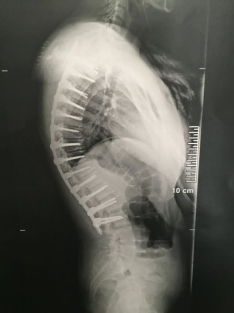 La Cyphose | Docteur Pierre Moreno - Chirurgien du rachis