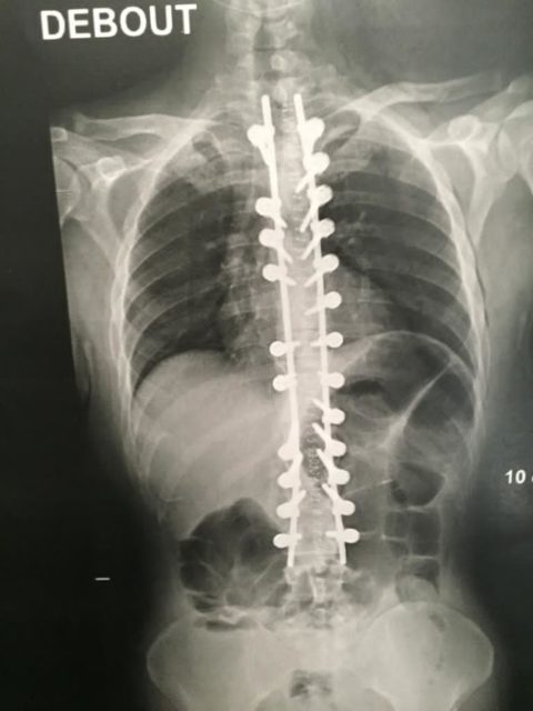 La Cyphose | Docteur Pierre Moreno - Chirurgien du rachis