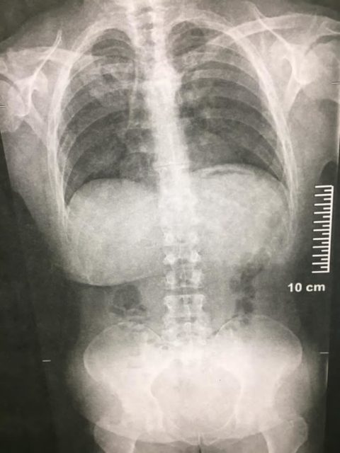 La Cyphose | Docteur Pierre Moreno - Chirurgien du rachis